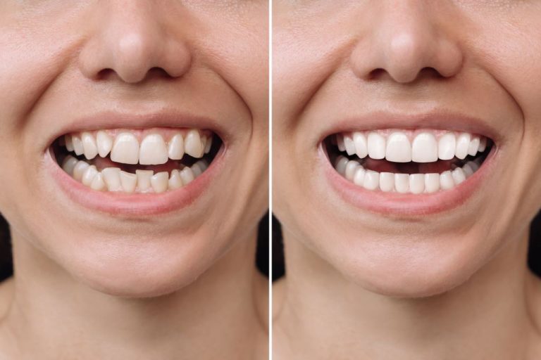 Qual é A Forma Mais Eficaz De Alinhar Os Dentes? Confira As Dicas ...